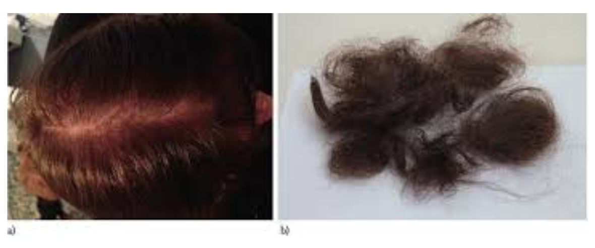 Telogen Effluvium – Fidore Health Blogs